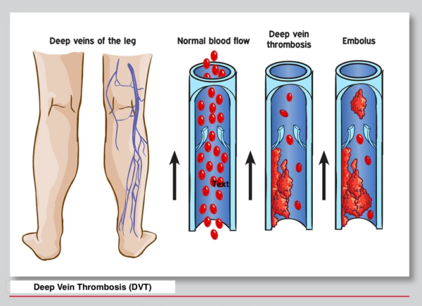 VA Disability Rating for Deep Vein Thrombosis - VA Benefits Consultants