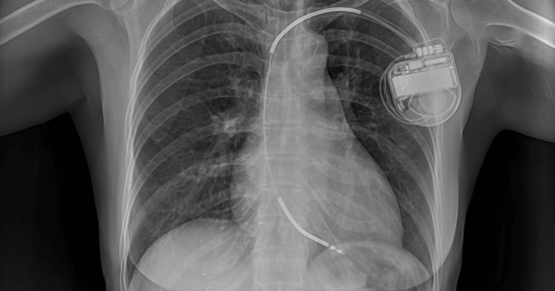 va heart stents pacemakers surgery - VA Benefits Consultants