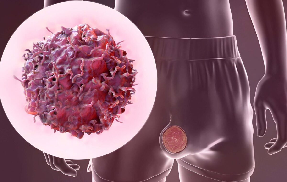 Testicular cancer and other conditions - VA Benefits Consultants