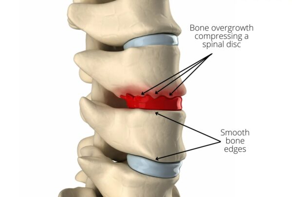 Bone spurs - VA Benefits Consultants