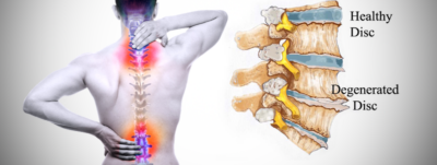 Degenerative disc disease - VA Benefits Consultants
