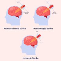 Stroke - VA Benefits Consultants